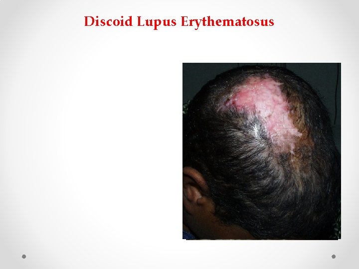 Cutaneous manifestation of SLE and other CTD Diseases