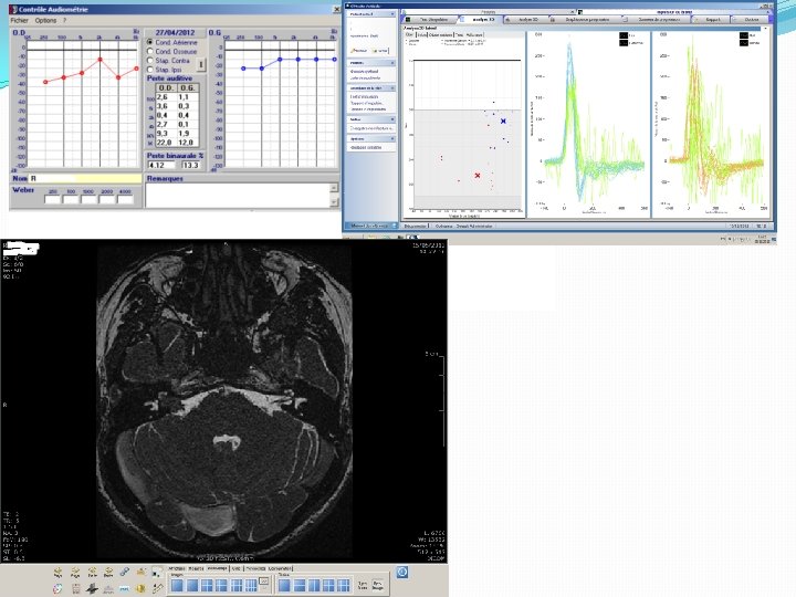 INTERET DU TEST HIT COMPARAISON AVEC LE TEST