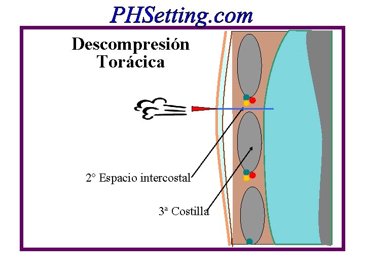 Trauma Torcico LESIN TORCICA HIPOXIA TISULAR Oxigenacin inadecuada