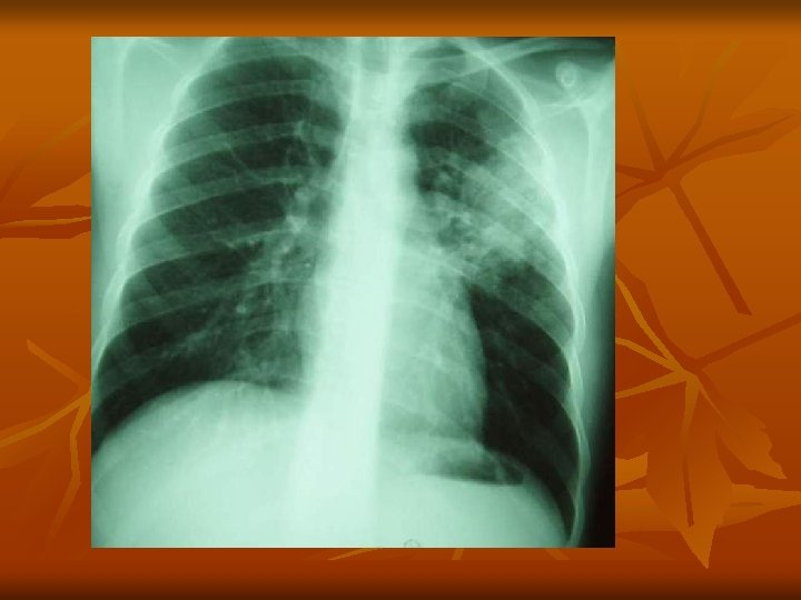 NEUMONIA n n La neumona es la infeccin