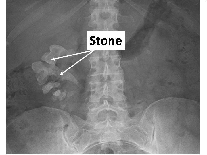 Kidney Stones An Overview Gerald Da Roza MD