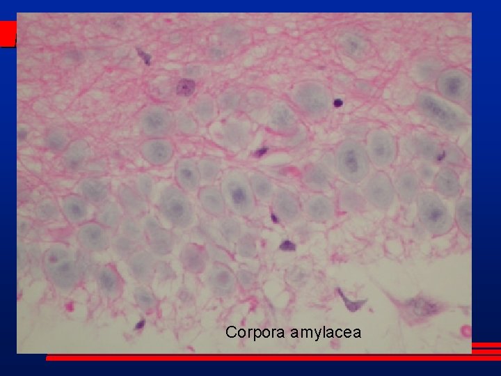 SOME BODIES IN THE BRAIN Noon Diagnostic Conference