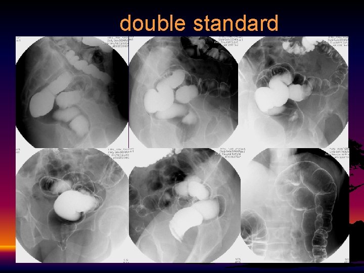 cecum ascending colon transverse colon descending colon sigmoid