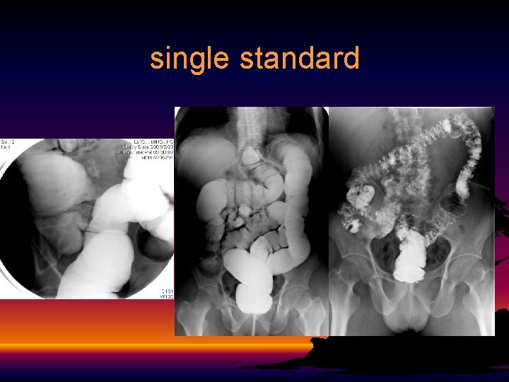 cecum ascending colon transverse colon descending colon sigmoid