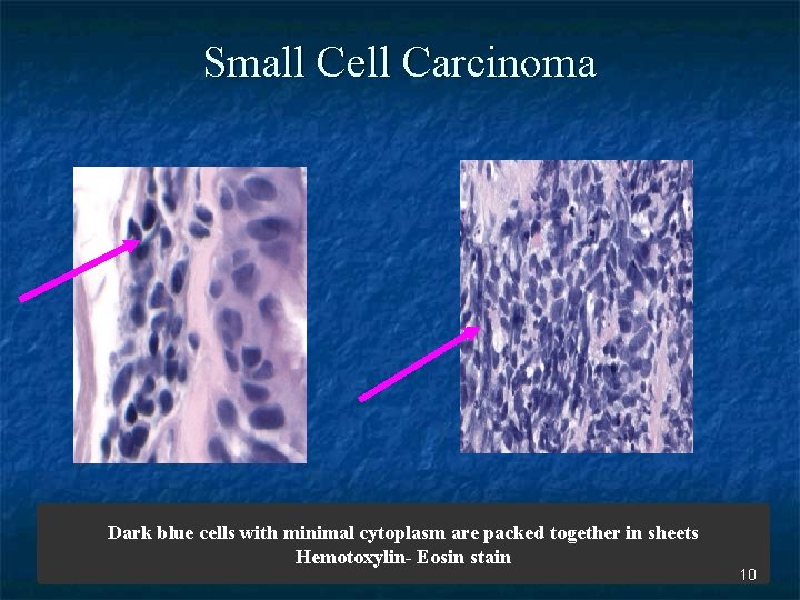 Part 10 C Histopathology of small cell lung