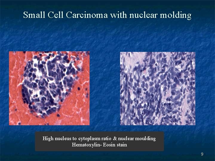 Part 10 C Histopathology of small cell lung