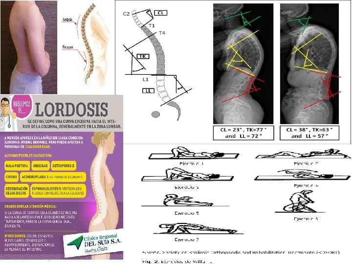 CIFOSIS DEFINICIN ETIOLOGA SIGNOS Y SINTOMAS Existen 2