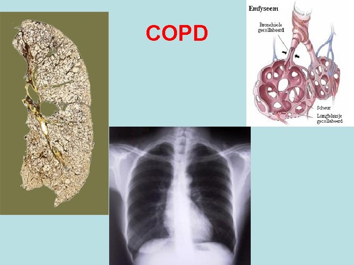 Verbranding en ademhaling Gezonde en ongezonde longen BS