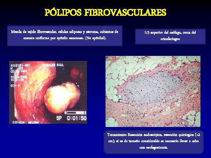 Tumores de Esofago Dr Manuel Alejandro Martinez Vazquez