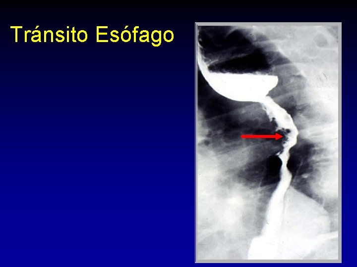 Tumores de Esofago Dr Manuel Alejandro Martinez Vazquez