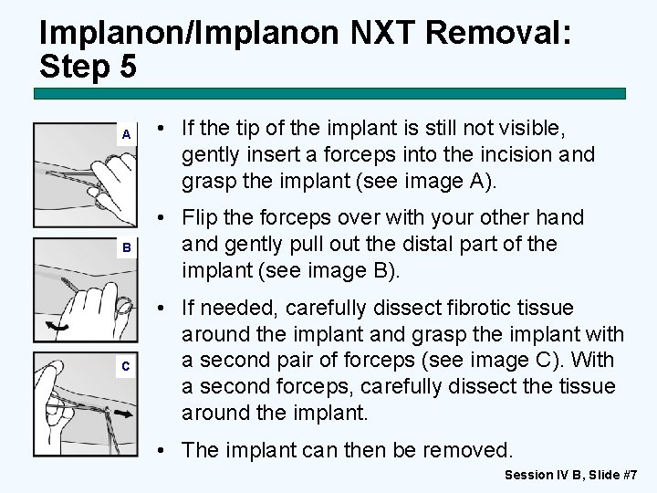 Contraceptive Implants Session IV B OneRod Implant Removal