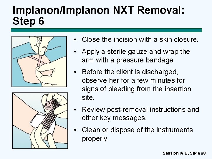 Contraceptive Implants Session IV B OneRod Implant Removal