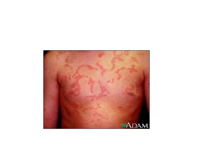 Should an allergic reaction like Solar Urticaria be