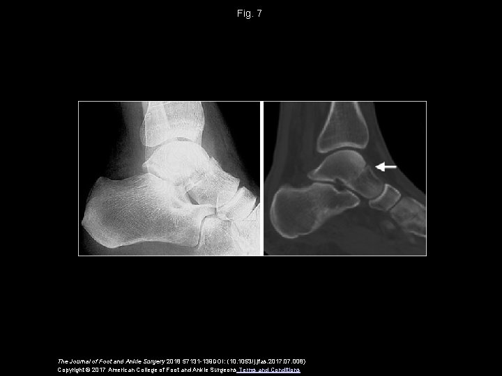 Defining Talar Head and Neck Pathology The Malvern
