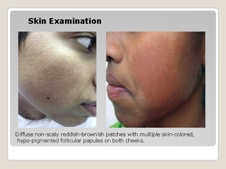 Erythromelanosis Follicularis Faciei A Case Report and Review
