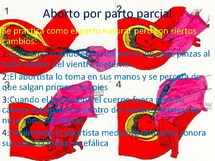 El aborto JOSELYN CULQUI QUE ES El aborto