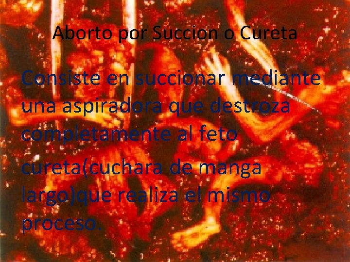 El aborto JOSELYN CULQUI QUE ES El aborto
