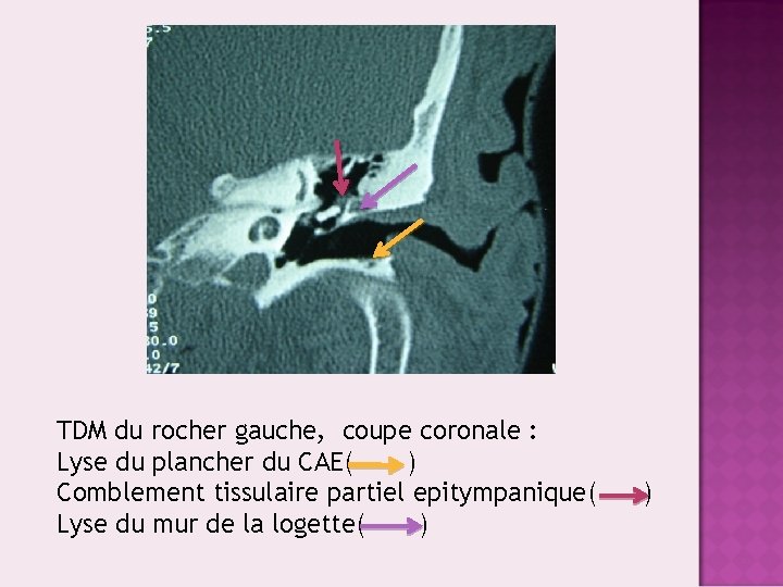 Le cholesteatome primitif du conduit auditif externe propos