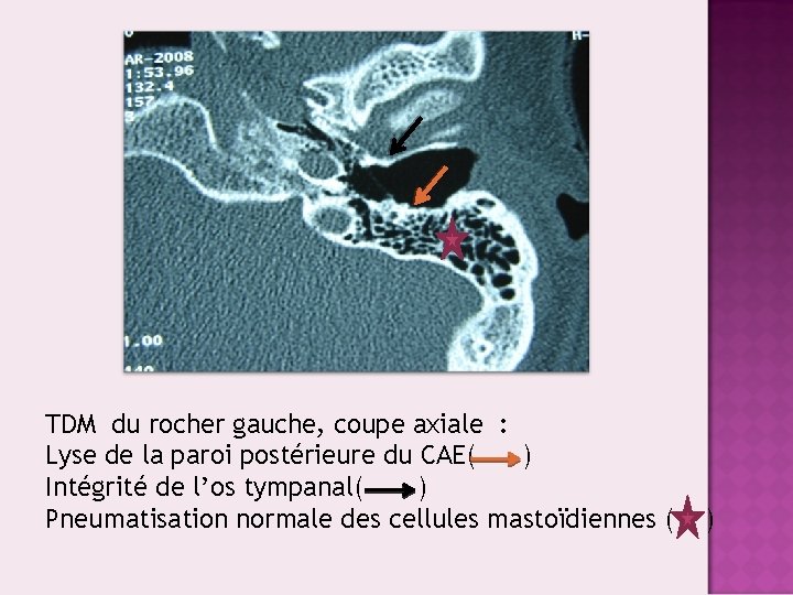 Le cholesteatome primitif du conduit auditif externe propos
