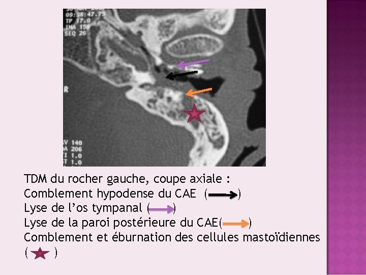Le cholesteatome primitif du conduit auditif externe propos