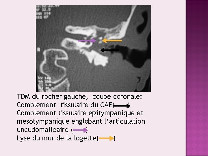 Le cholesteatome primitif du conduit auditif externe propos