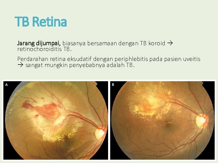 Tuberkulosis Okular Marzarendra Dhion Erlangga RS Dr Moewardi