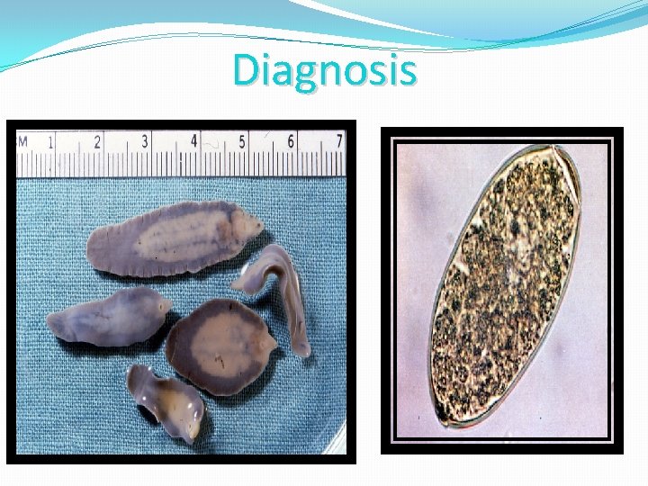 FASCIOLA HEPATICA FASCIOLA hepatica Disease Fascioliasis liver rot