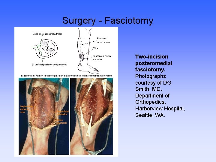 Principles of Orthopaedic Trauma Care Compartment Syndrome Alison