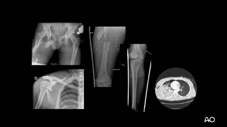 Management of the polytrauma patient clavicular femoral tibial