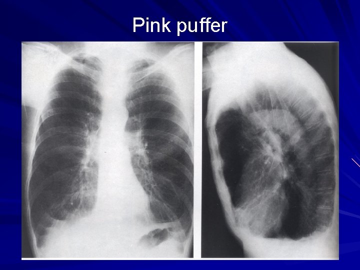 BPCO La broncopneumopatia cronica ostruttiva BPCO caratterizzata da