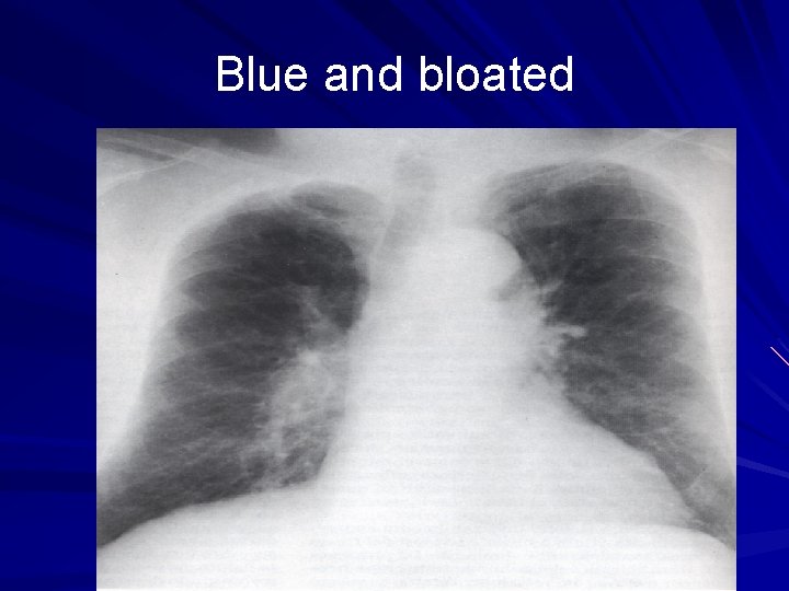 BPCO La broncopneumopatia cronica ostruttiva BPCO caratterizzata da