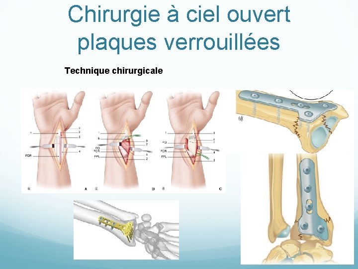 Fractures de lextrmit distale du radius de la