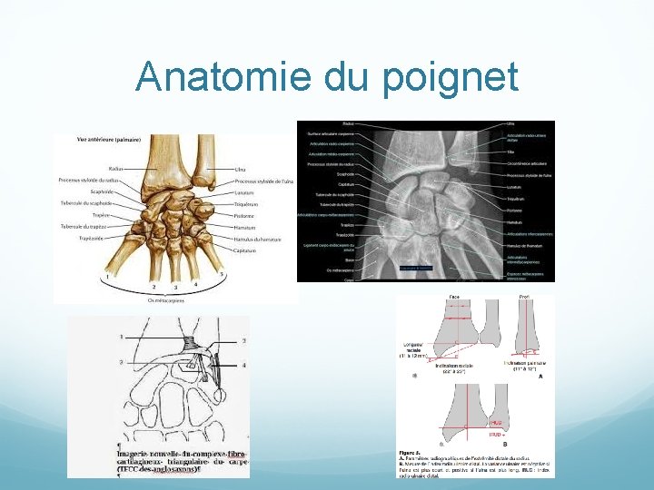 Fractures de lextrmit distale du radius de la