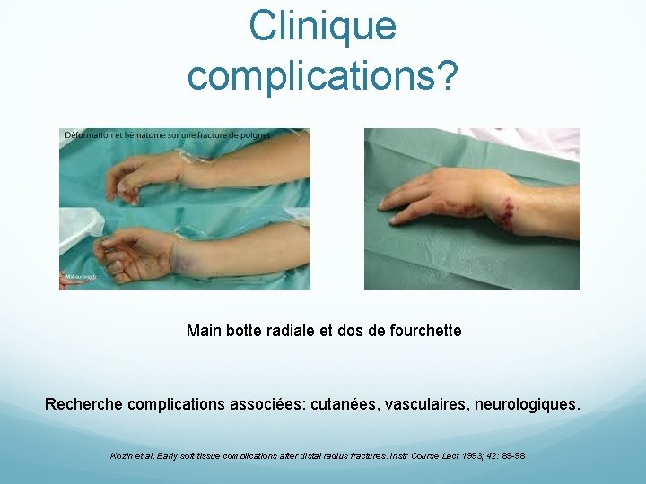 Fractures de lextrmit distale du radius de la