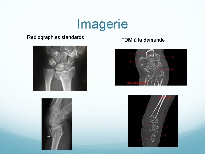 Fractures de lextrmit distale du radius de la