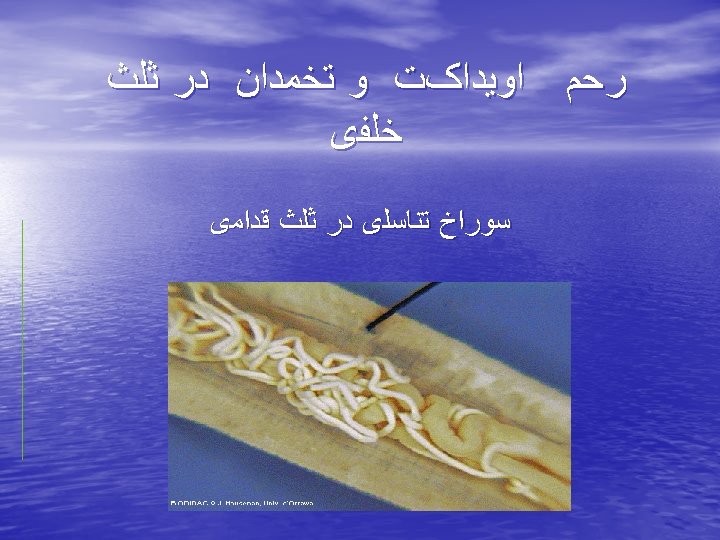 Ascaris lumbricoides Ascariasis Synonym Large round worm of