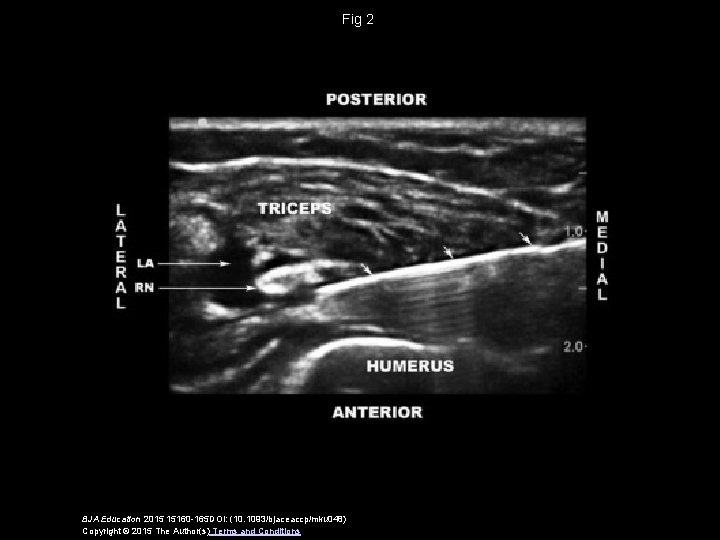 Ultrasoundguided peripheral nerve blocks of the upper limb