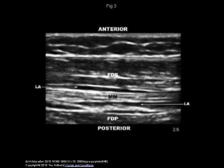Ultrasoundguided peripheral nerve blocks of the upper limb