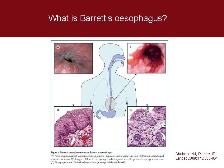 The Northern Ireland Barretts Register incidence and risk