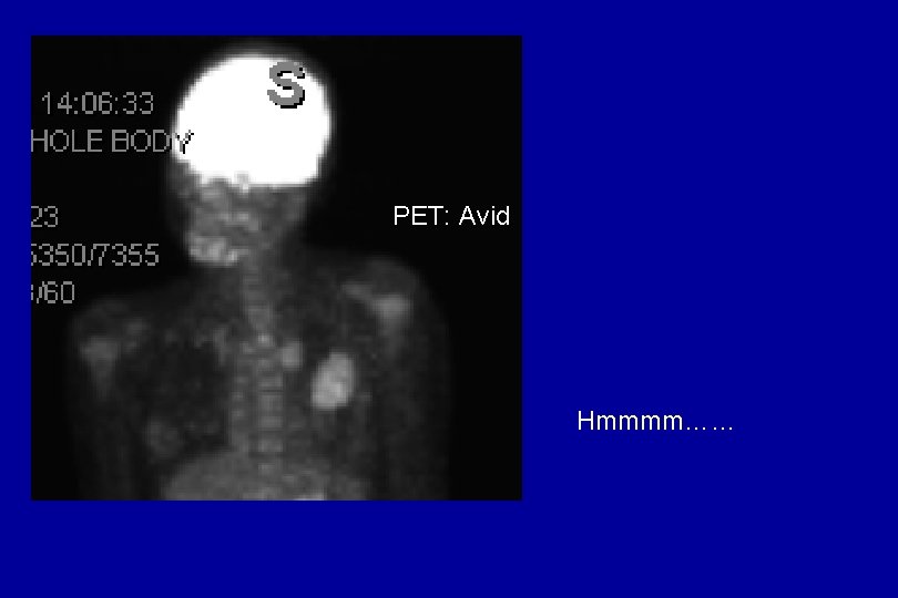 PETCT Fusion Imaging and SUV Assessment Using MIMvista
