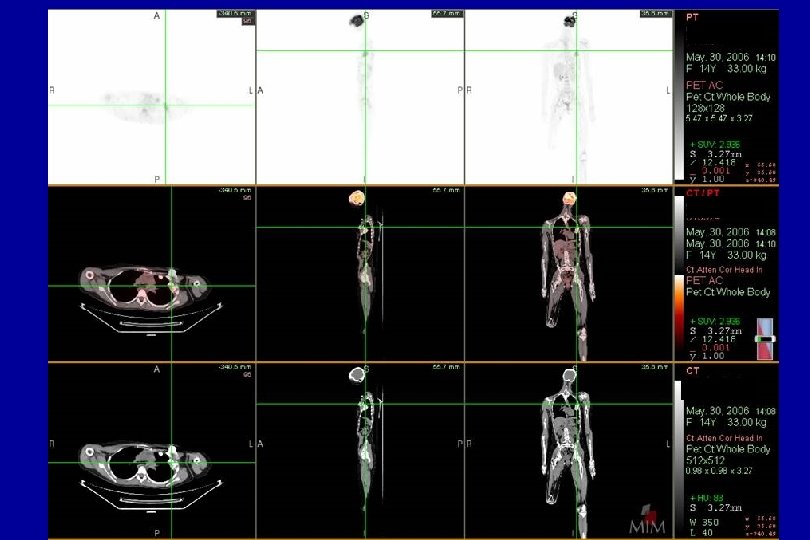 PETCT Fusion Imaging and SUV Assessment Using MIMvista