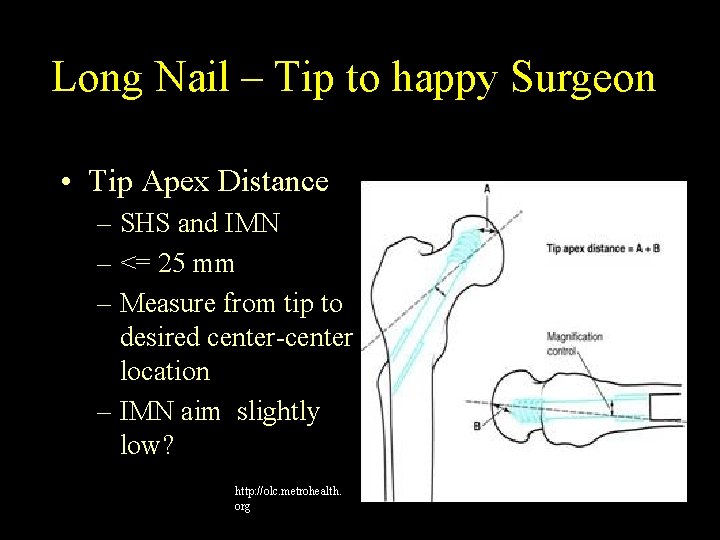 IT hip Fractures Long is the Only Way