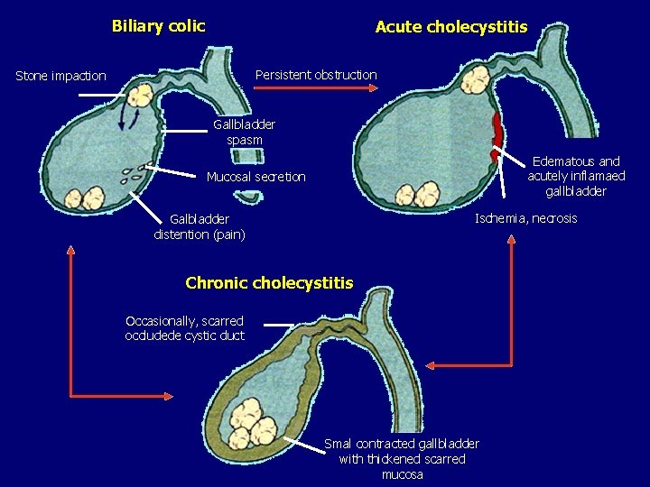 GALLSTONE DISEASE Prof Dr Ahmet Dobrucal Cerrahpaa Tp