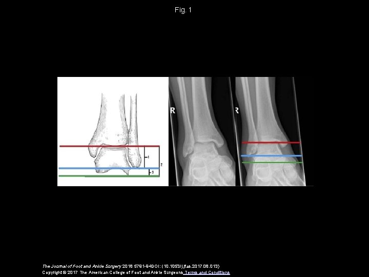 Radiographic Assessment of Fibular Length Variance The Case