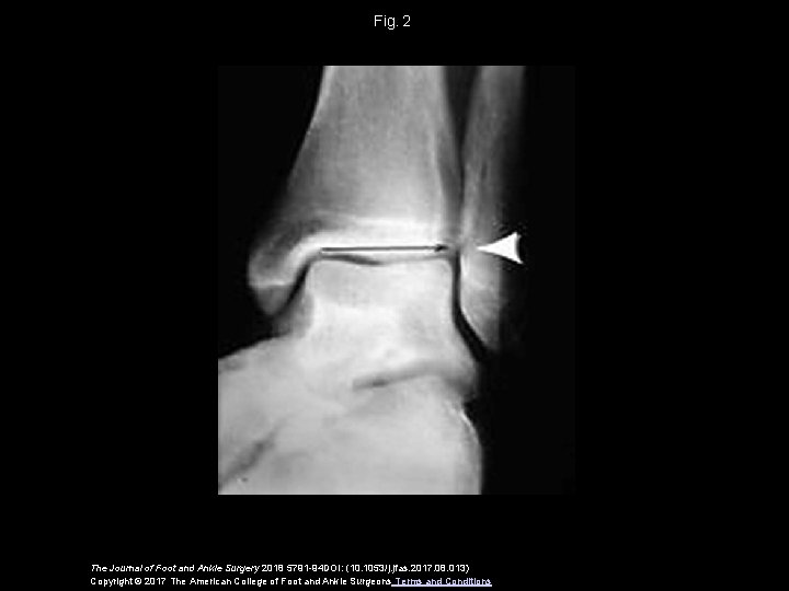 Radiographic Assessment of Fibular Length Variance The Case