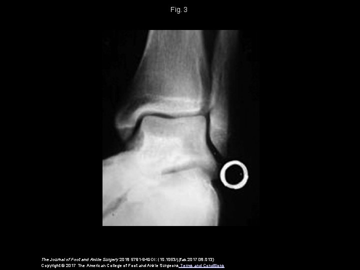 Radiographic Assessment of Fibular Length Variance The Case