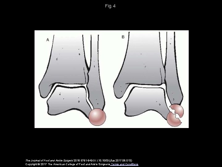 Radiographic Assessment of Fibular Length Variance The Case