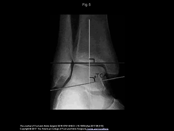 Radiographic Assessment of Fibular Length Variance The Case