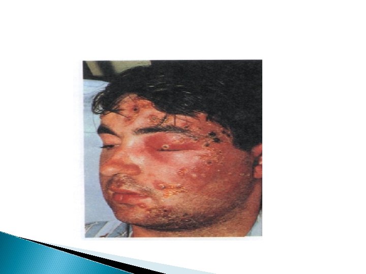 SSTI skin and soft tissue infection By Dr