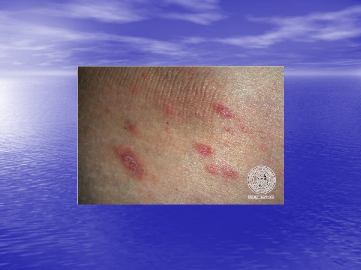 PAPULOSQUAMOUS DISEASES I Pityriasis rosea Lichen planus PITYRIASIS